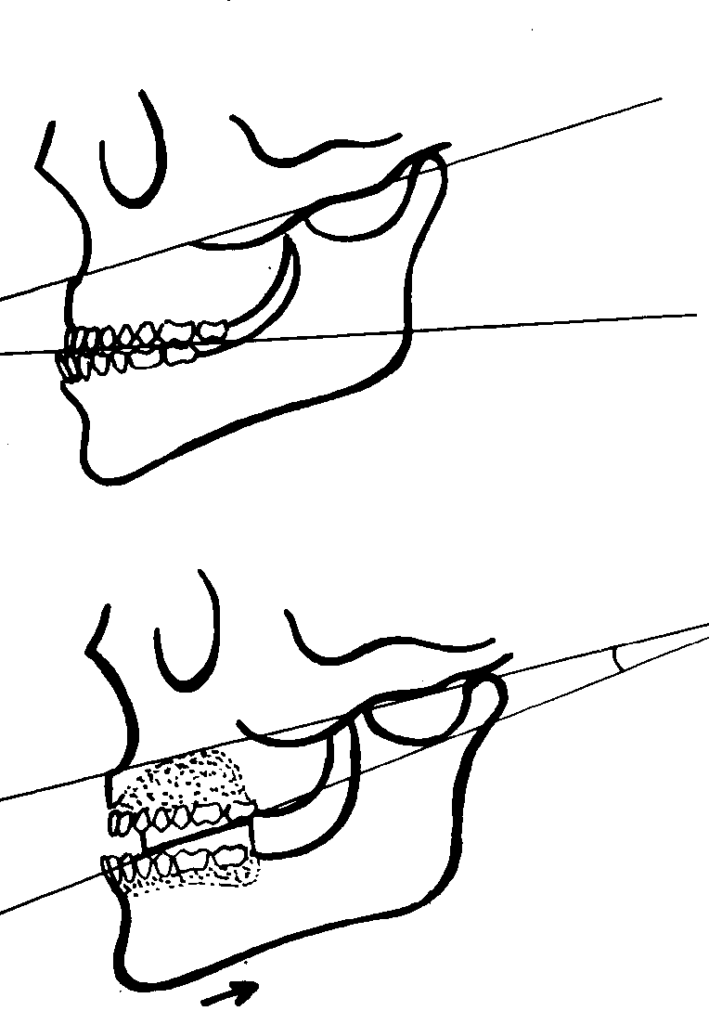 Réhabilitation neuro occlusive ou technique de Planas | eorthodontie