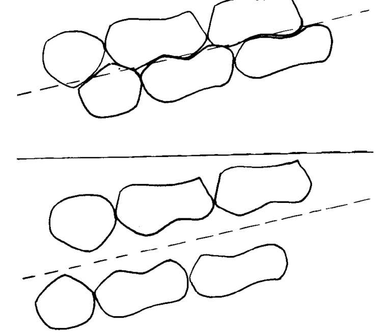 Réhabilitation neuro occlusive ou technique de Planas | eorthodontie