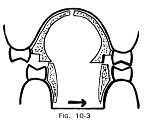 Réhabilitation neuro occlusive ou technique de Planas | eorthodontie